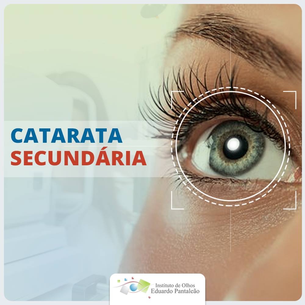 Catarata Secundária | Dr. Eduardo Pantaleão