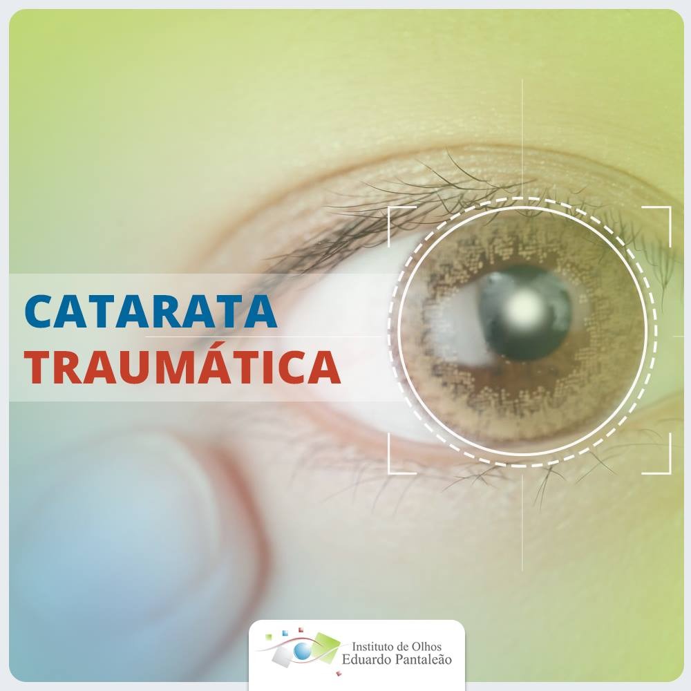 Catarata Traumática | Dr. Eduardo Pantaleão